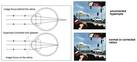 Optometry Eye Diseases in Windsor, ON | Dr Brian Blake